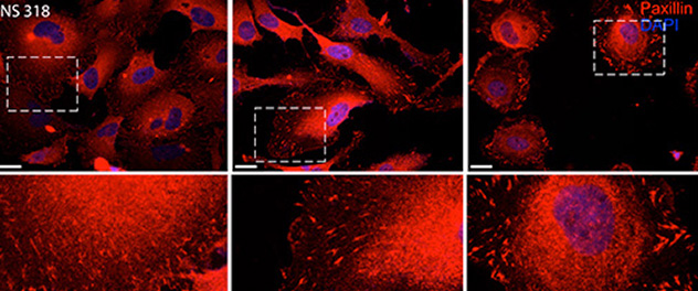 Tumor Invasion and Metastasis - Department of Cancer Biology - Mayo ...